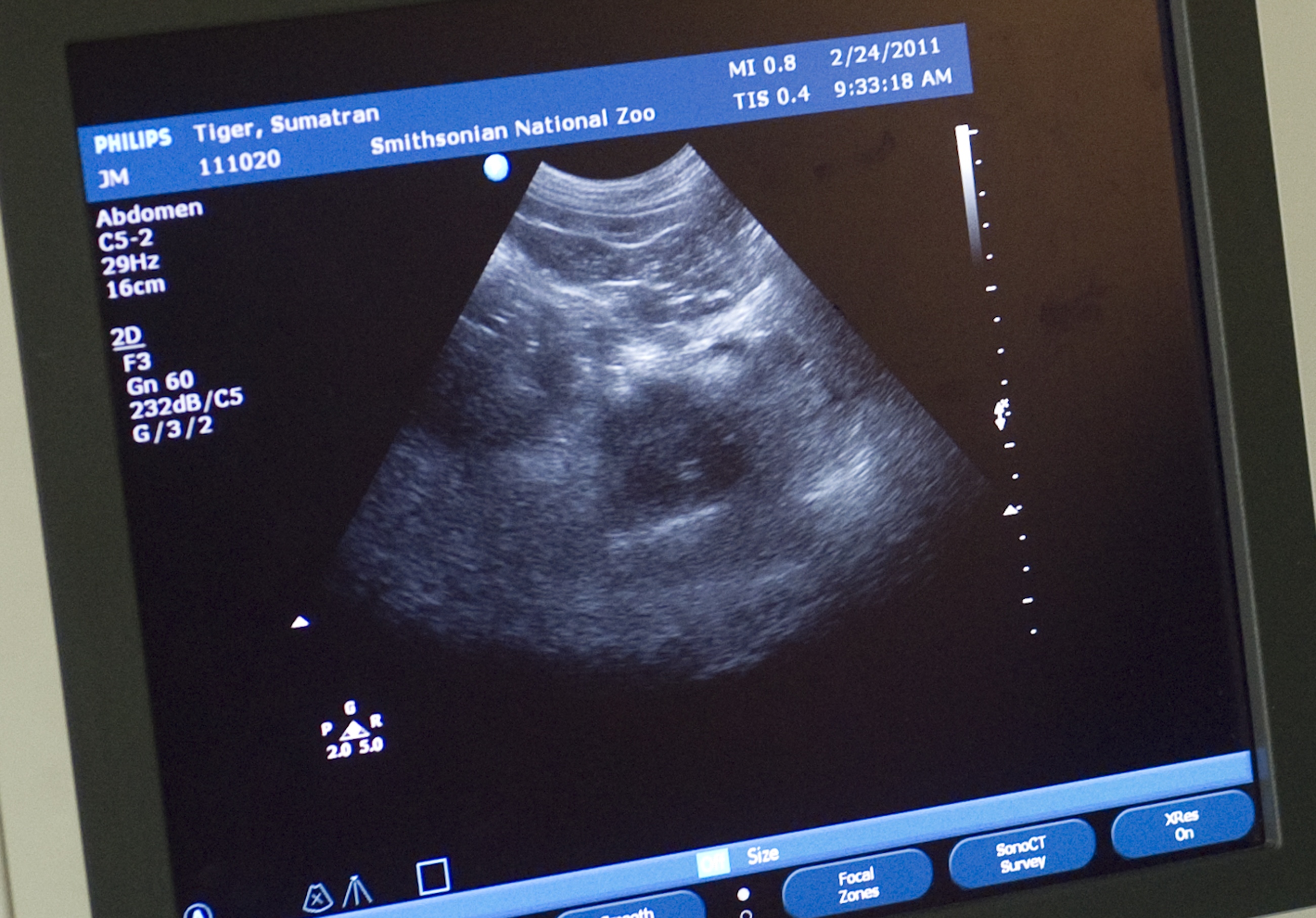 Ultrasound treatment for prostate cancer may reduce side effects, study ...