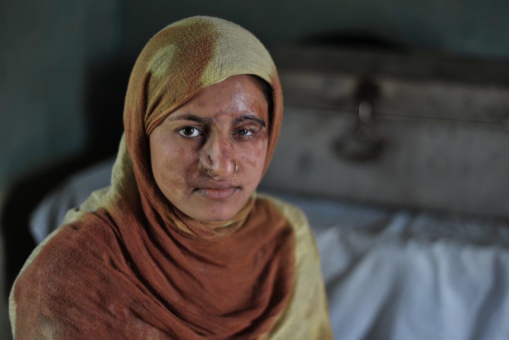Pakistan acid attacks continue despite new laws - The World from PRX