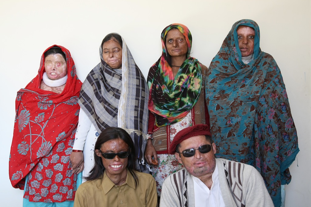 Pakistan's acid attack survivors - The World from PRX