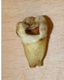 John Lennon's tooth for sale - The World from PRX