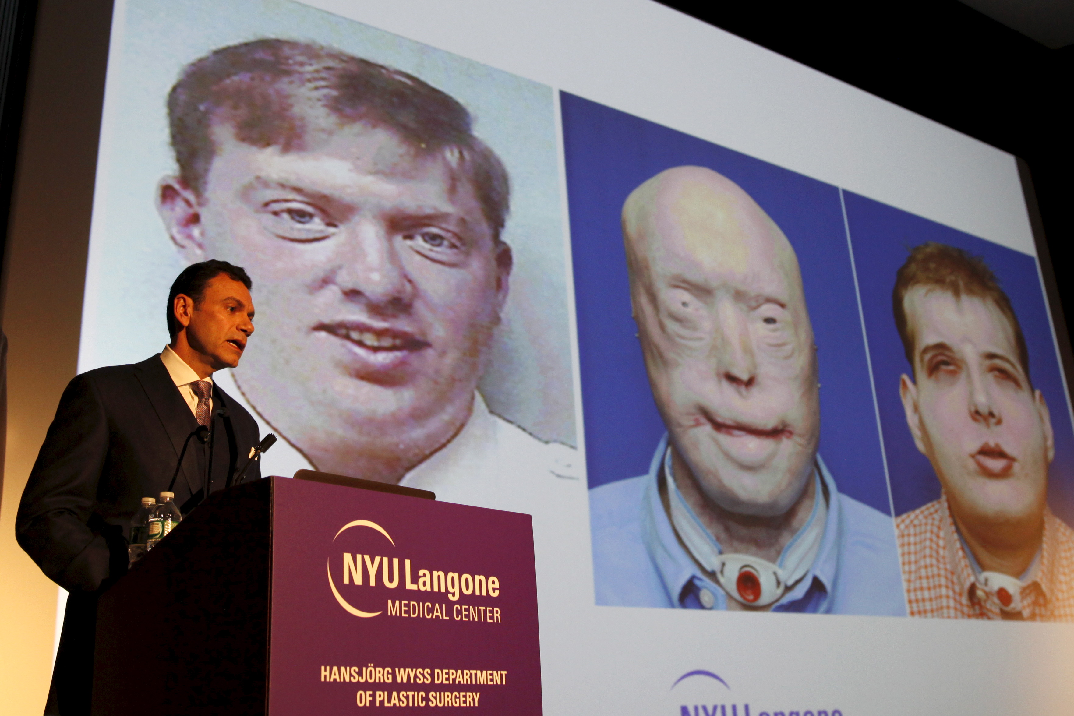 10 years and 36 operations later, face transplants are still tricky ...