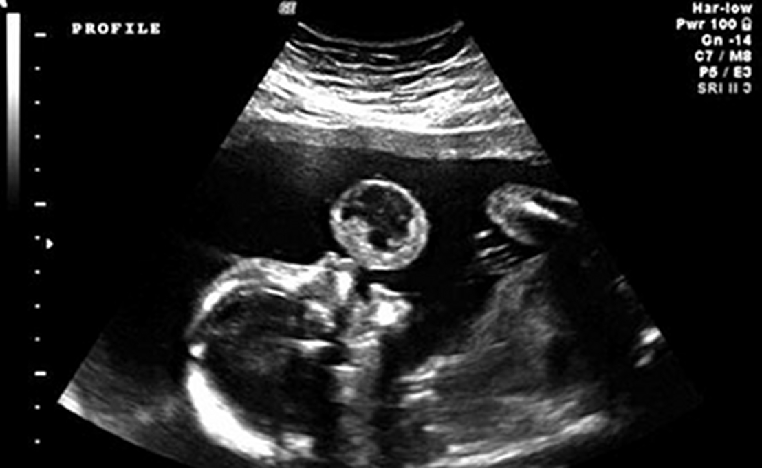 Miami doctors remove tumor from fetus in world's first operation - The ...